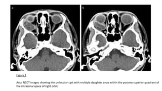 hydatid disease involving the orbit.pptx
