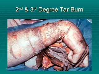 hydraulic_safety for forklift and engine.ppt