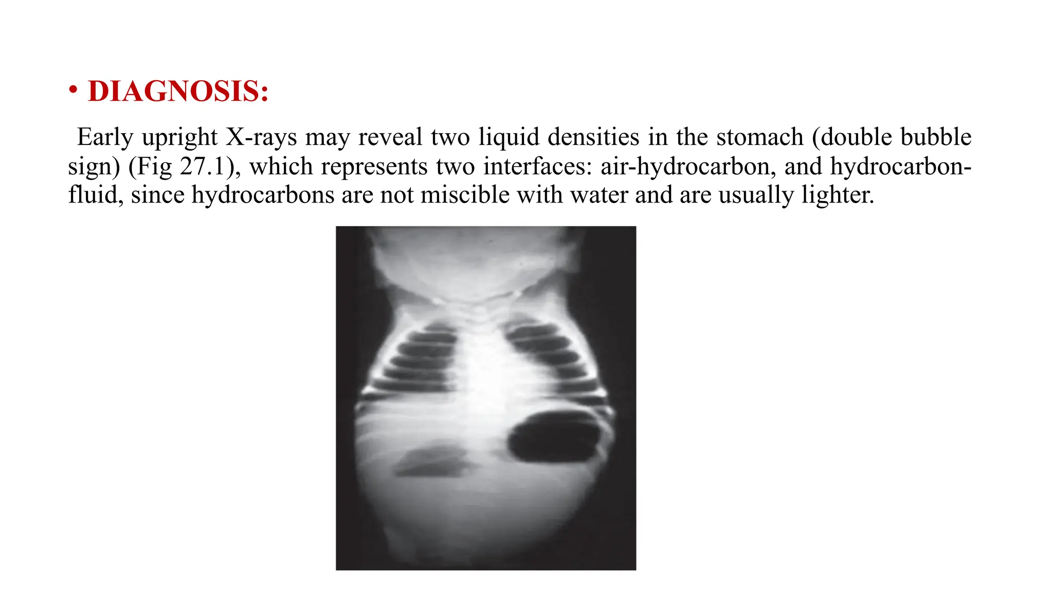 HYDROCARBON poisoning. Clinical manifestation, Management | PPTX