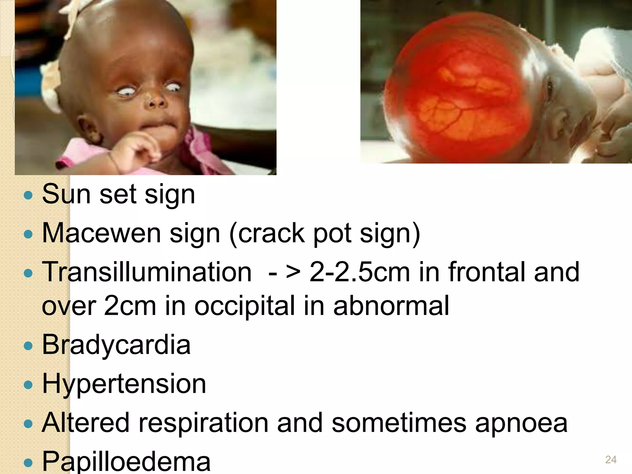 Hydrocephalus | PPTX