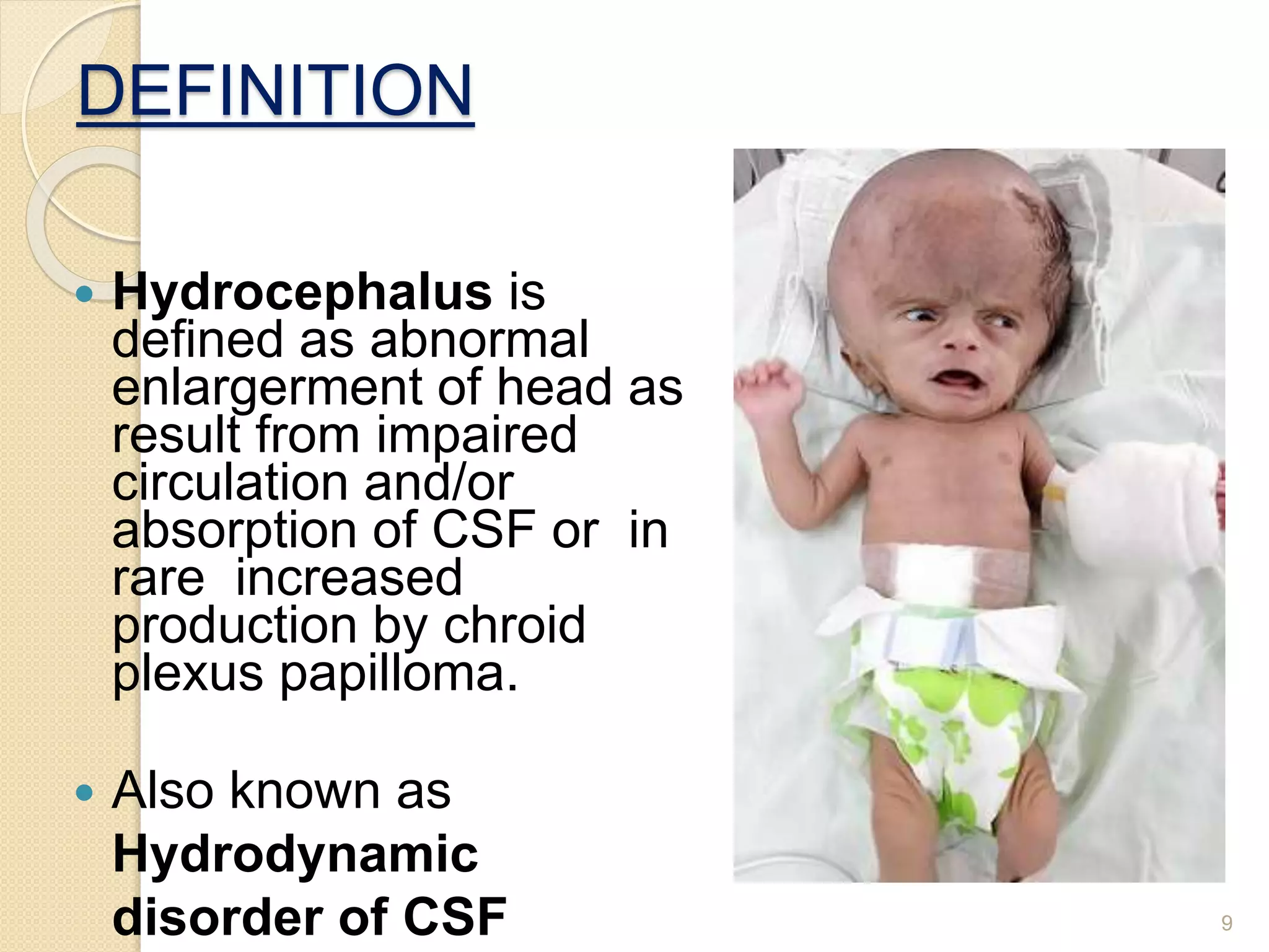 Hydrocephalus | PPTX