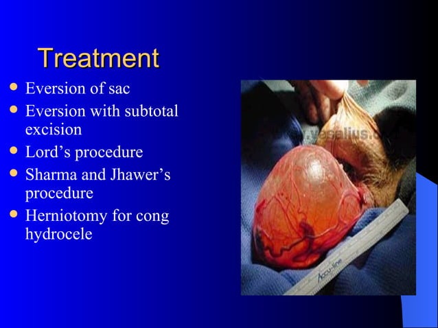 Hydrocele: A common tropical problem. | PPT