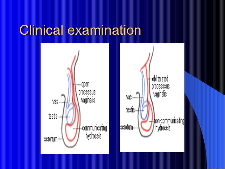 Hydrocele: A common tropical problem.