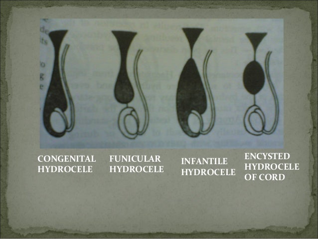 Hydrocele