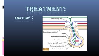 Hydrocele management | PPT