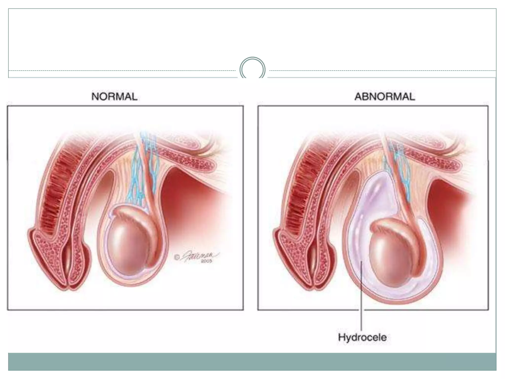 Hydrocele | PPTX