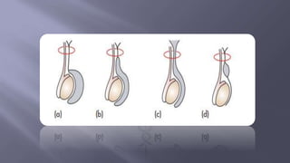 Hydrocele | PPTX