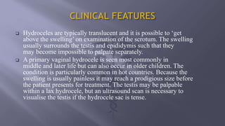 Hydrocele | PPTX