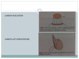 Hydrocele Seminar - A comprehensive review of literature | PPT