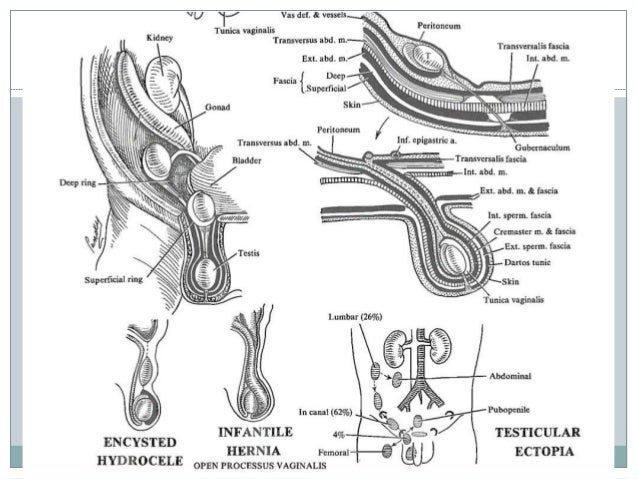 Hydrocele Seminar - A comprehensive review of literature