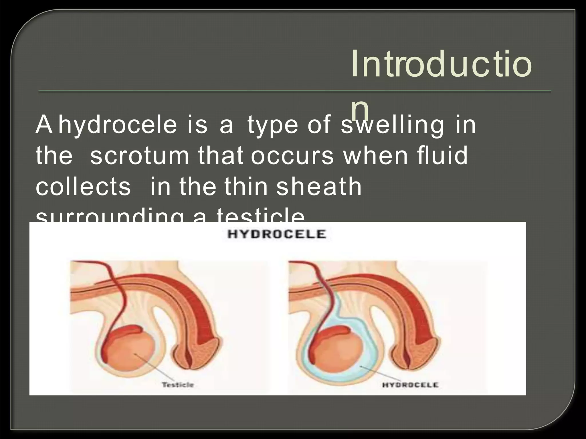 Hydrocele For Nursing Student Under Medical Surgical Nursing For G.N.M & B.Sc. Nursing. | PPTX