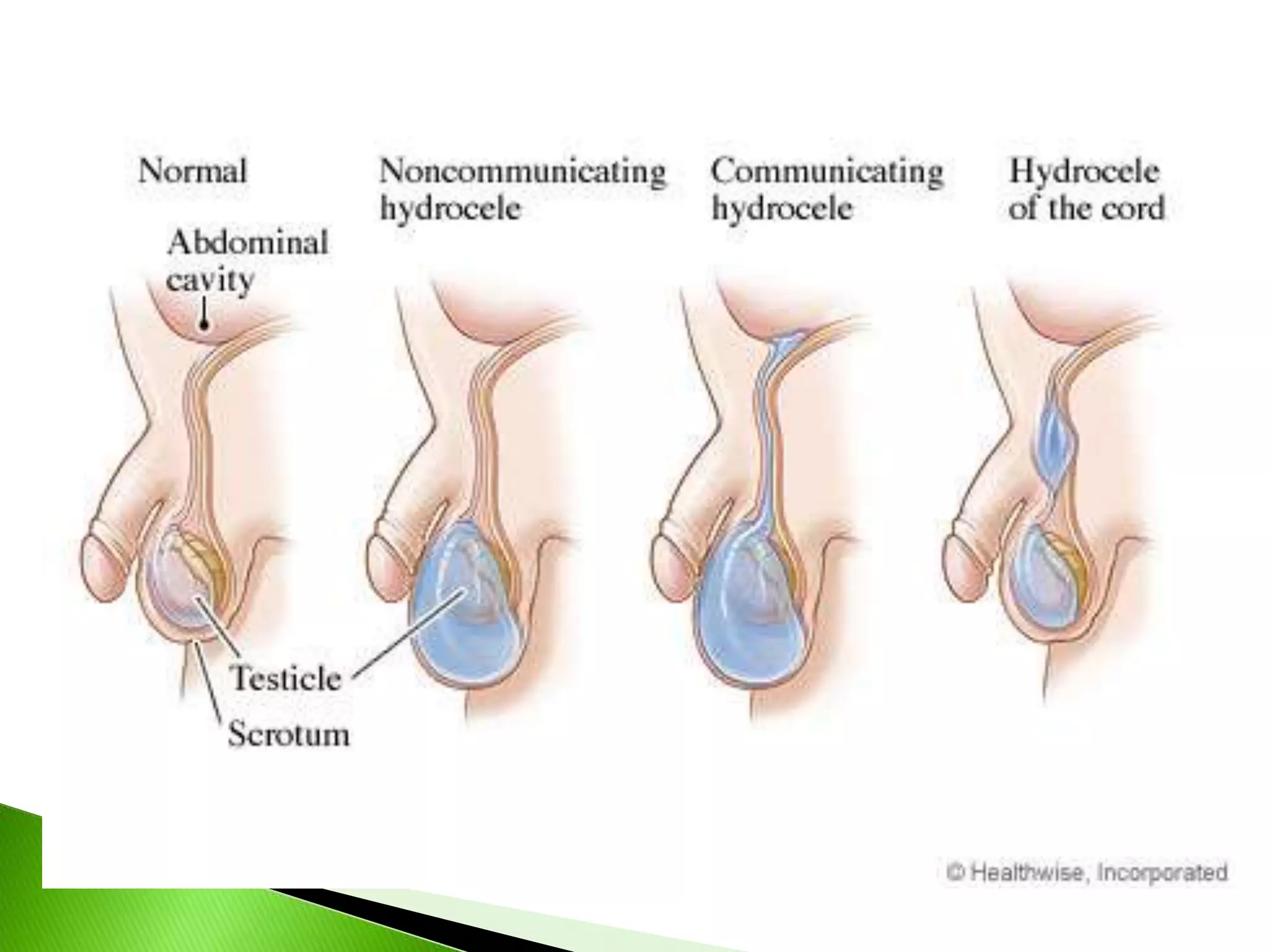 HYDROCELE.pptx | Infertility | Reproductive Health