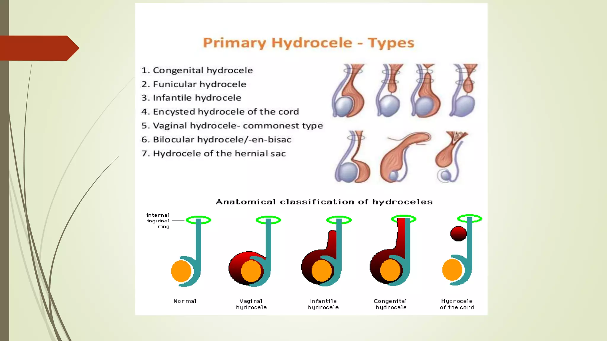 Hydrocele.pptx