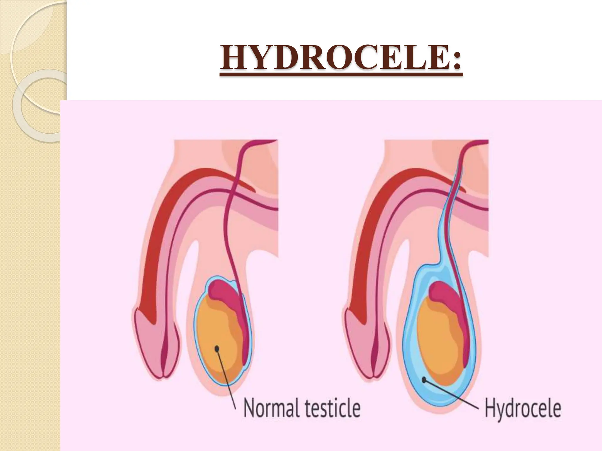 A lecture slide onHydrocele.pptx for nursing students | PPTX