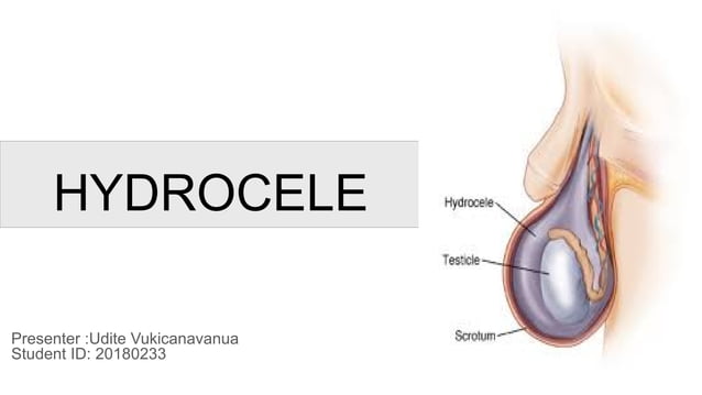HYDROCELE surgery lecture topic Slides 17.pptx