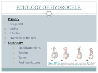 Hydrocele 2024,definition, causes treatment .pptx