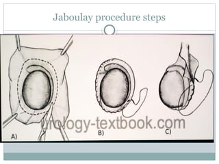 Hydrocele 2024,definition, causes treatment .pptx
