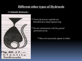 HYDROCELE , complications and its management | PPTX