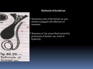 HYDROCELE , complications and its management | PPTX
