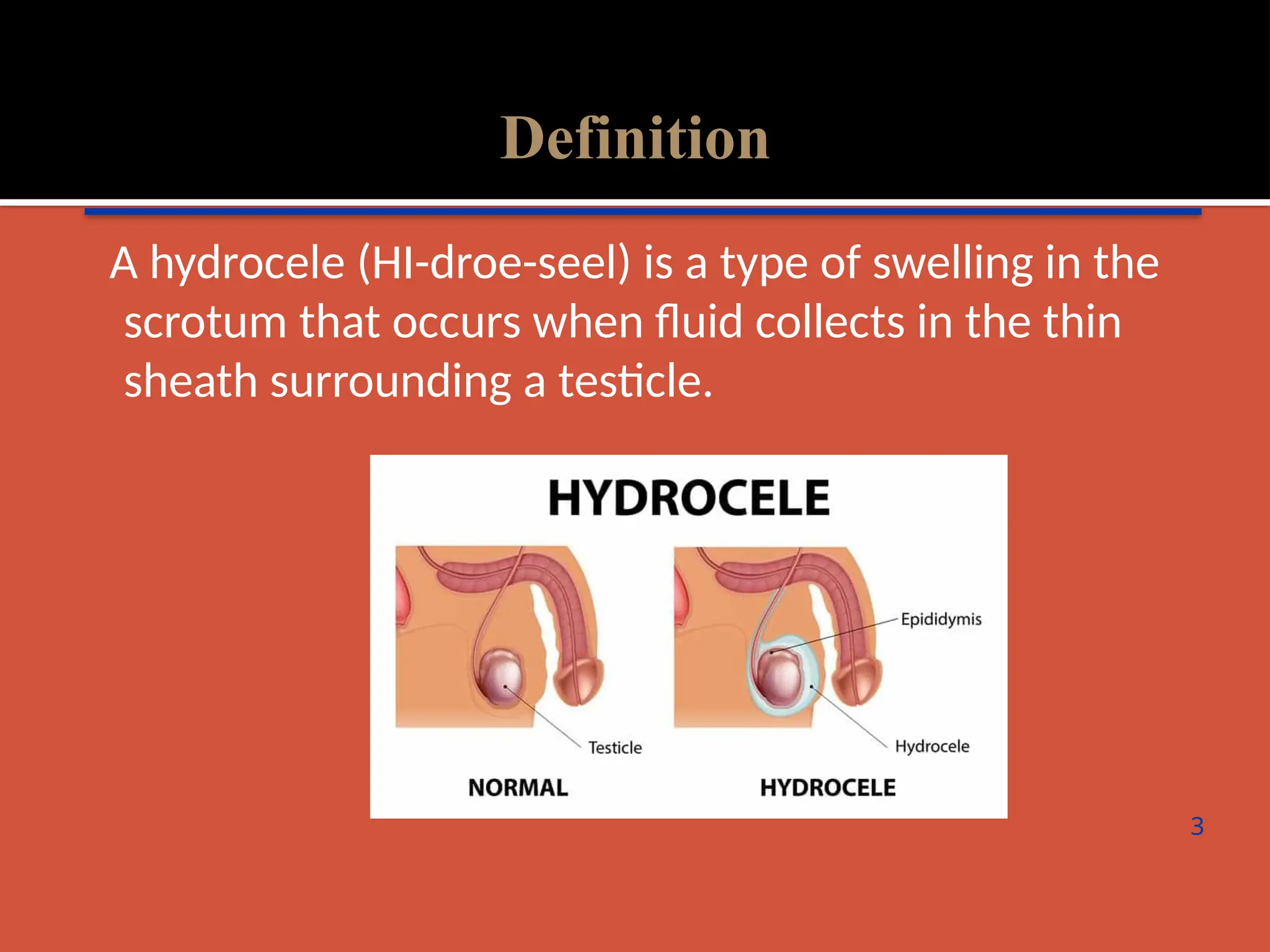 hydrocele mbbs topic new ppt uploded by dev | PPTX