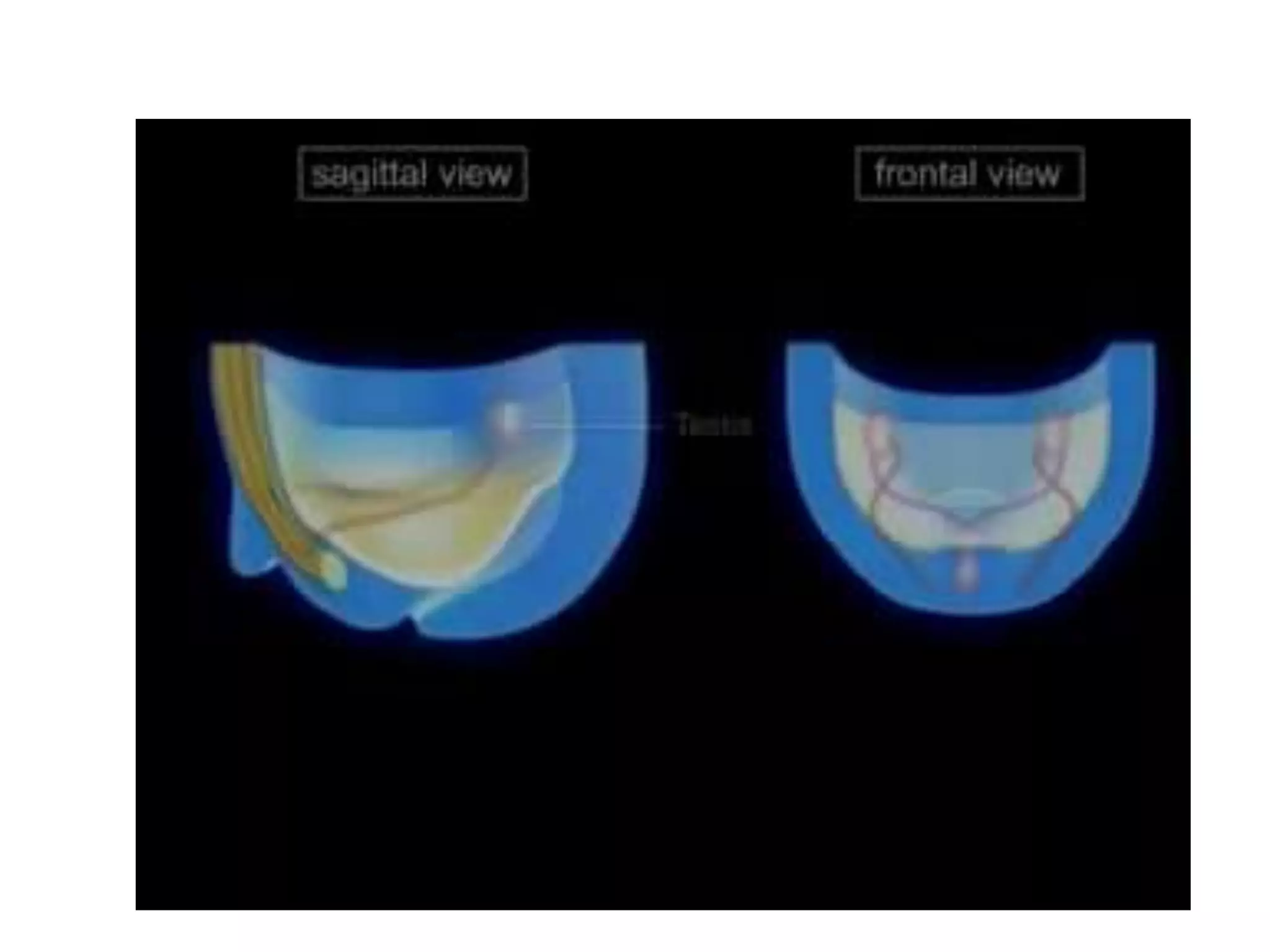 Hydrocele hidrokel anak optek aai | PPTX