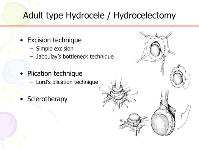 Hydrocele hidrokel anak optek aai | PPTX