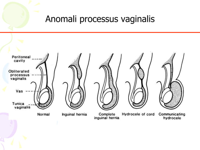 Hydrocele hidrokel anak optek aai | PPTX