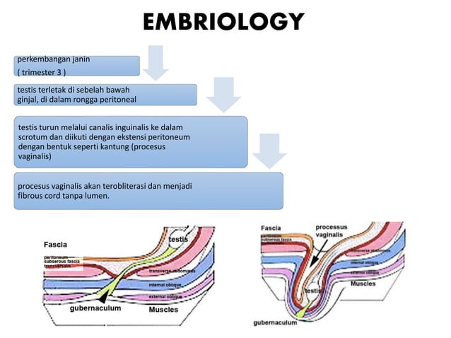 Hydrocele hidrokel anak optek aai | PPTX