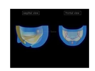 Hydrocele hidrokel anak optek aai | PPTX