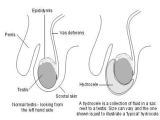 Hydrocele by tlali | PPTX