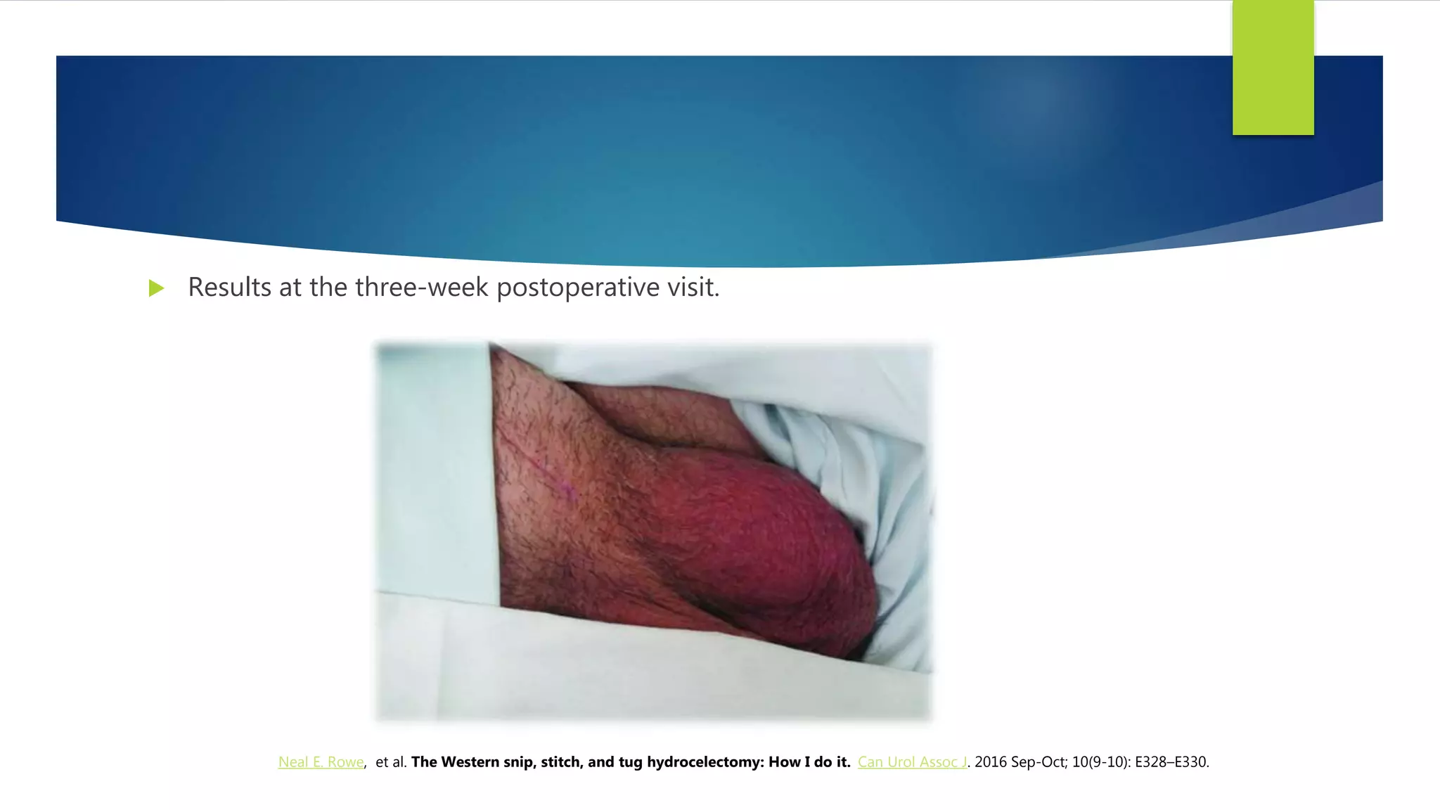 Hydrocelectomy | PPTX