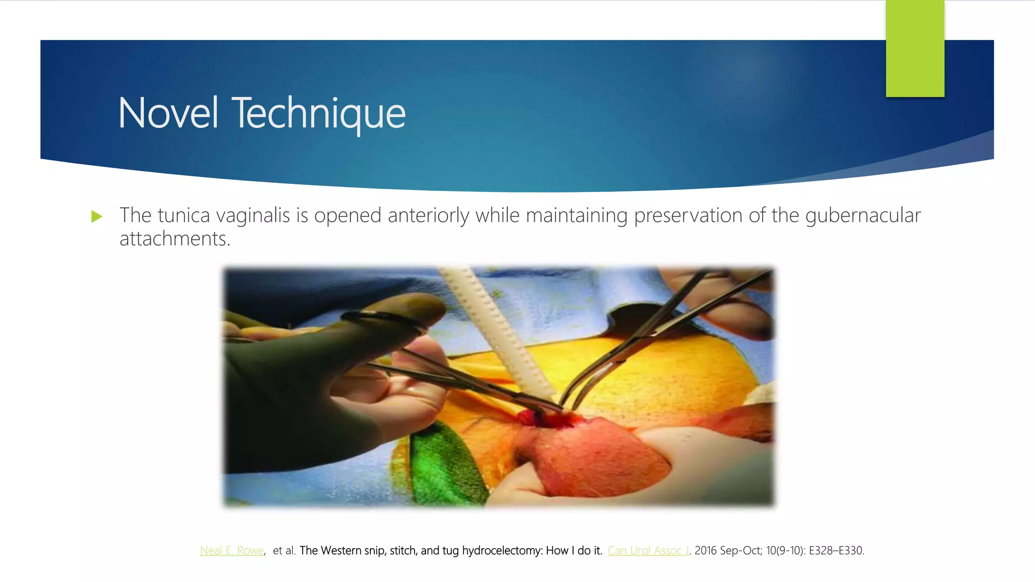 Hydrocelectomy | PPTX