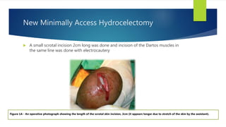 Hydrocelectomy | PPTX