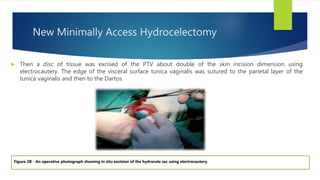Hydrocelectomy | PPTX