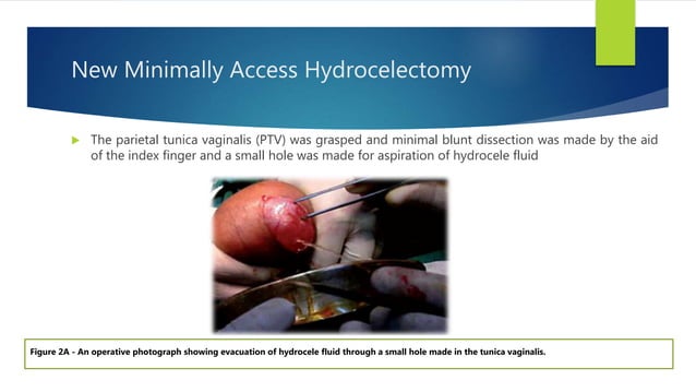 Hydrocelectomy