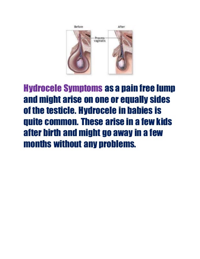 Hydrocele Define With Symptoms And Treatments