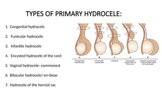 Hydrocele types and examination and management | PPTX