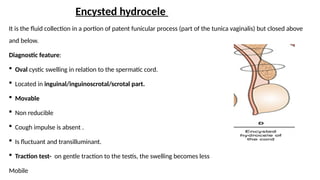 Hydrocele types and examination and management | PPTX