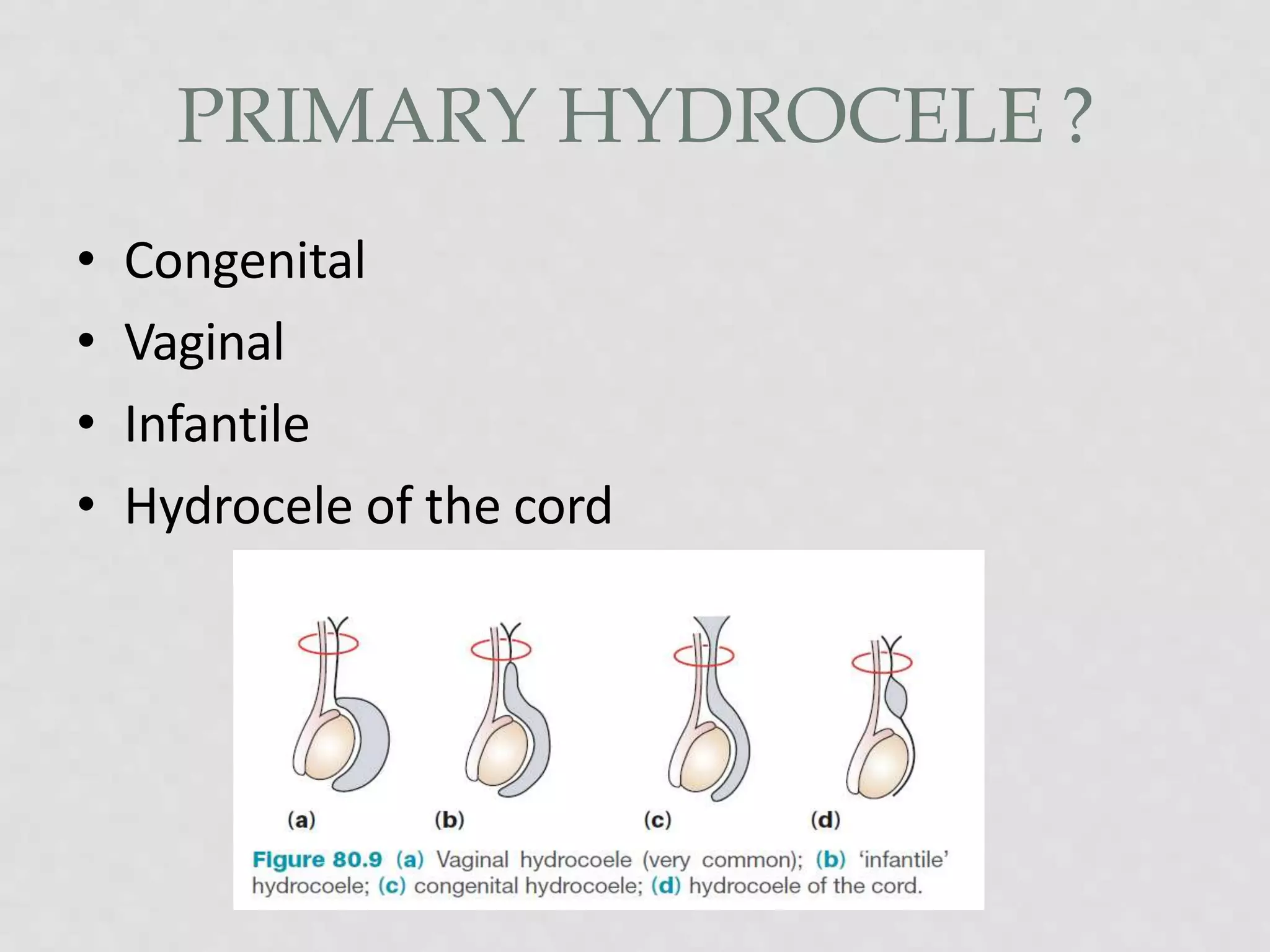 Hydrocele PPT.pptx