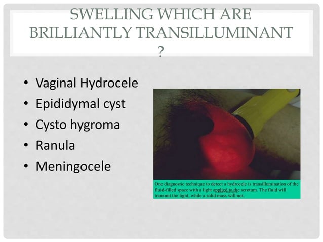 Hydrocele PPT.pptx | Sexual Conditions | Sexual Health