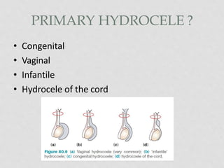 Hydrocele PPT.pptx