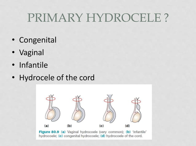 Hydrocele PPT.pptx | Sexual Conditions | Sexual Health