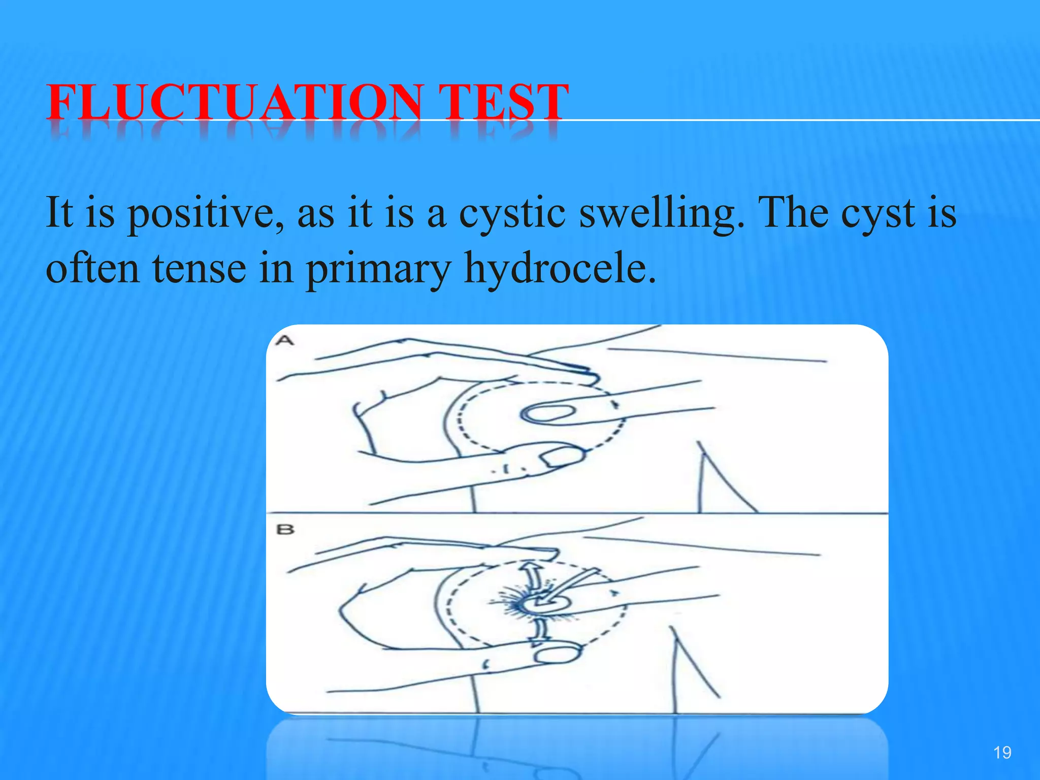 hydrocele ppt final.pptx