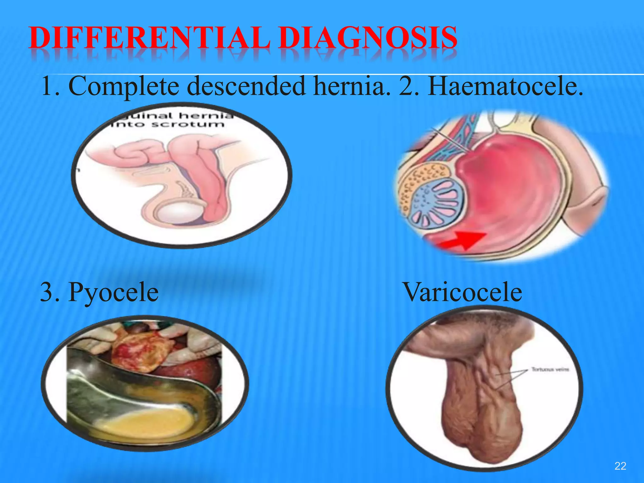hydrocele ppt final.pptx