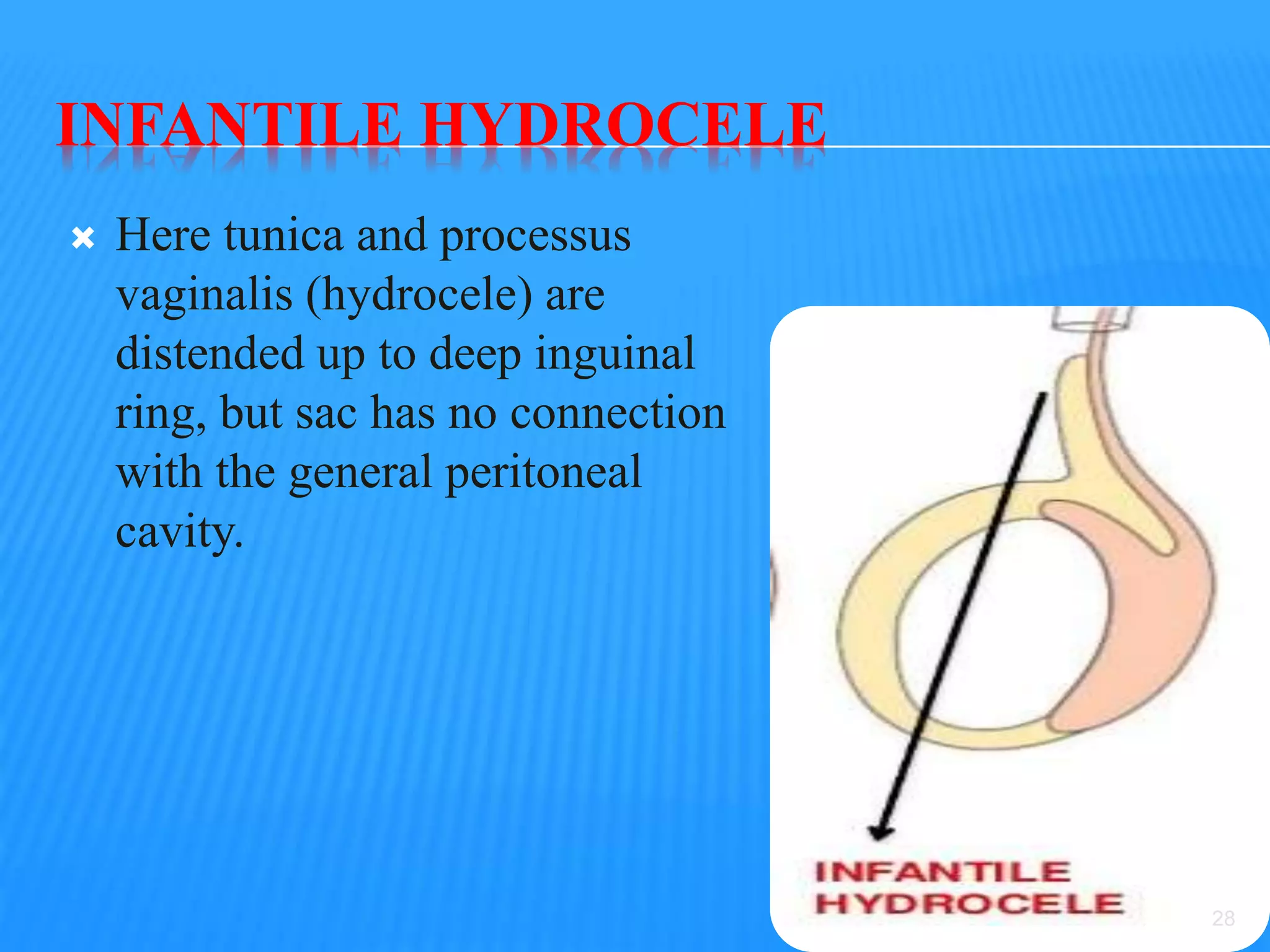 hydrocele ppt final.pptx