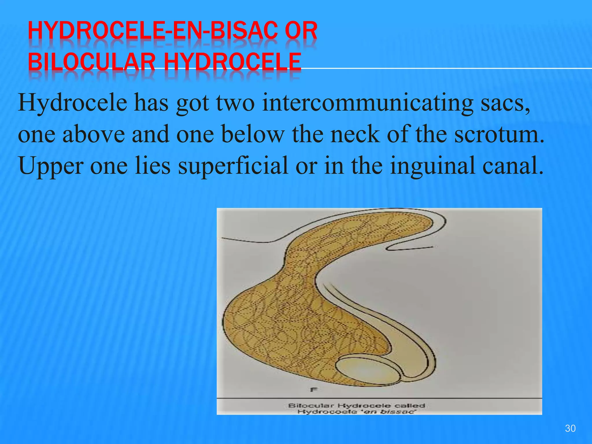 hydrocele ppt final.pptx