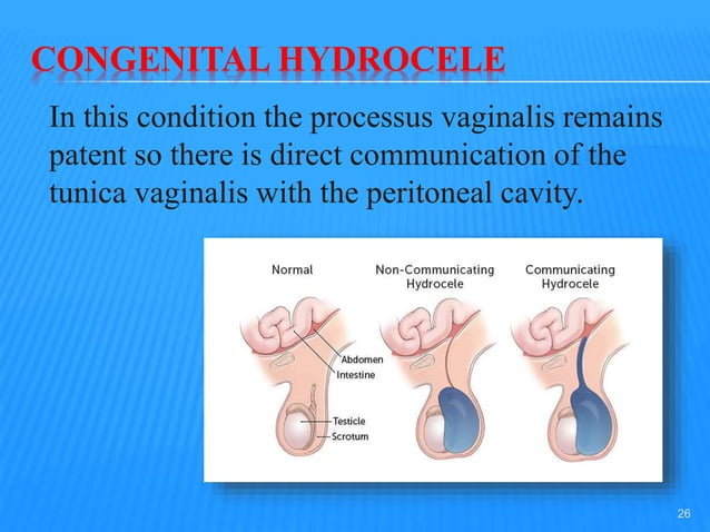 hydrocele ppt final.pptx