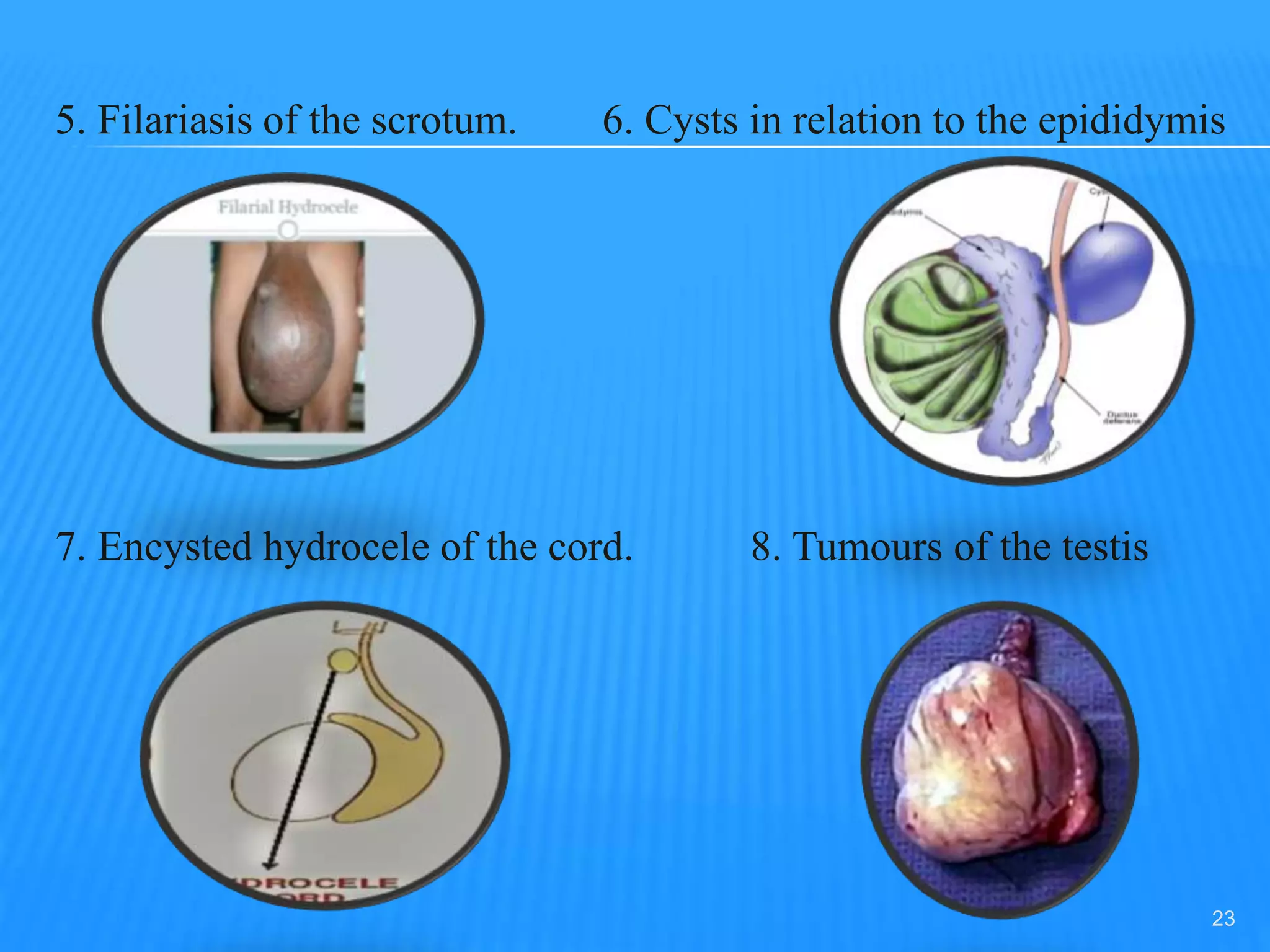 hydrocele ppt final.pptx