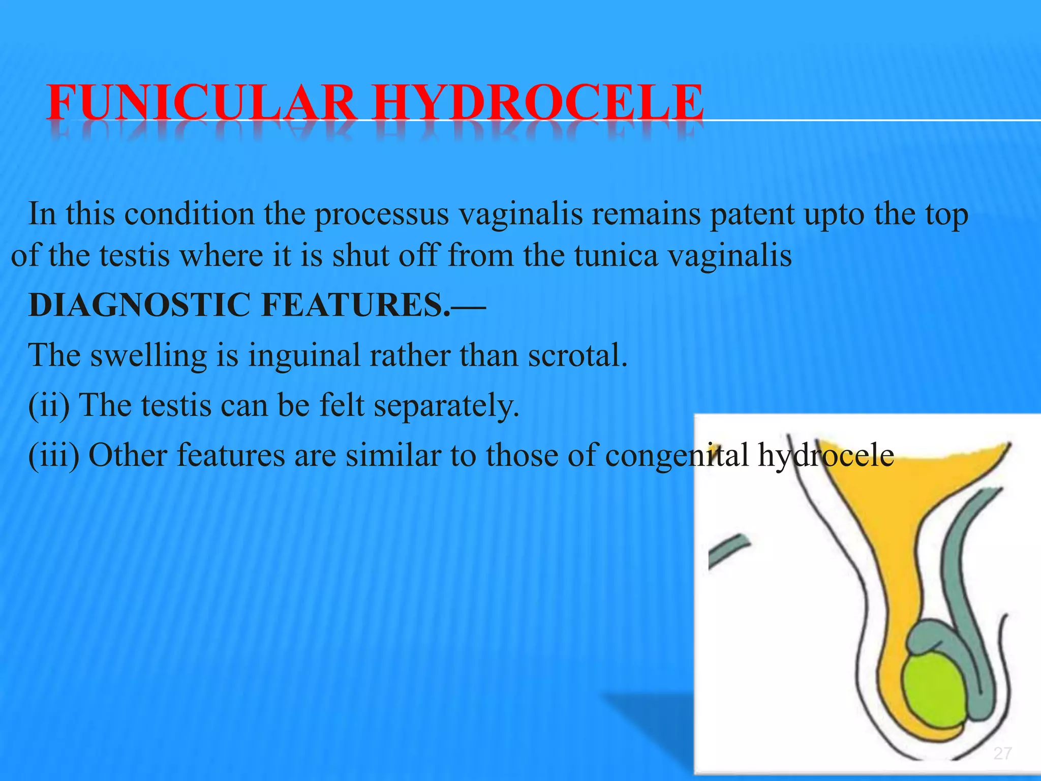 hydrocele ppt final.pptx