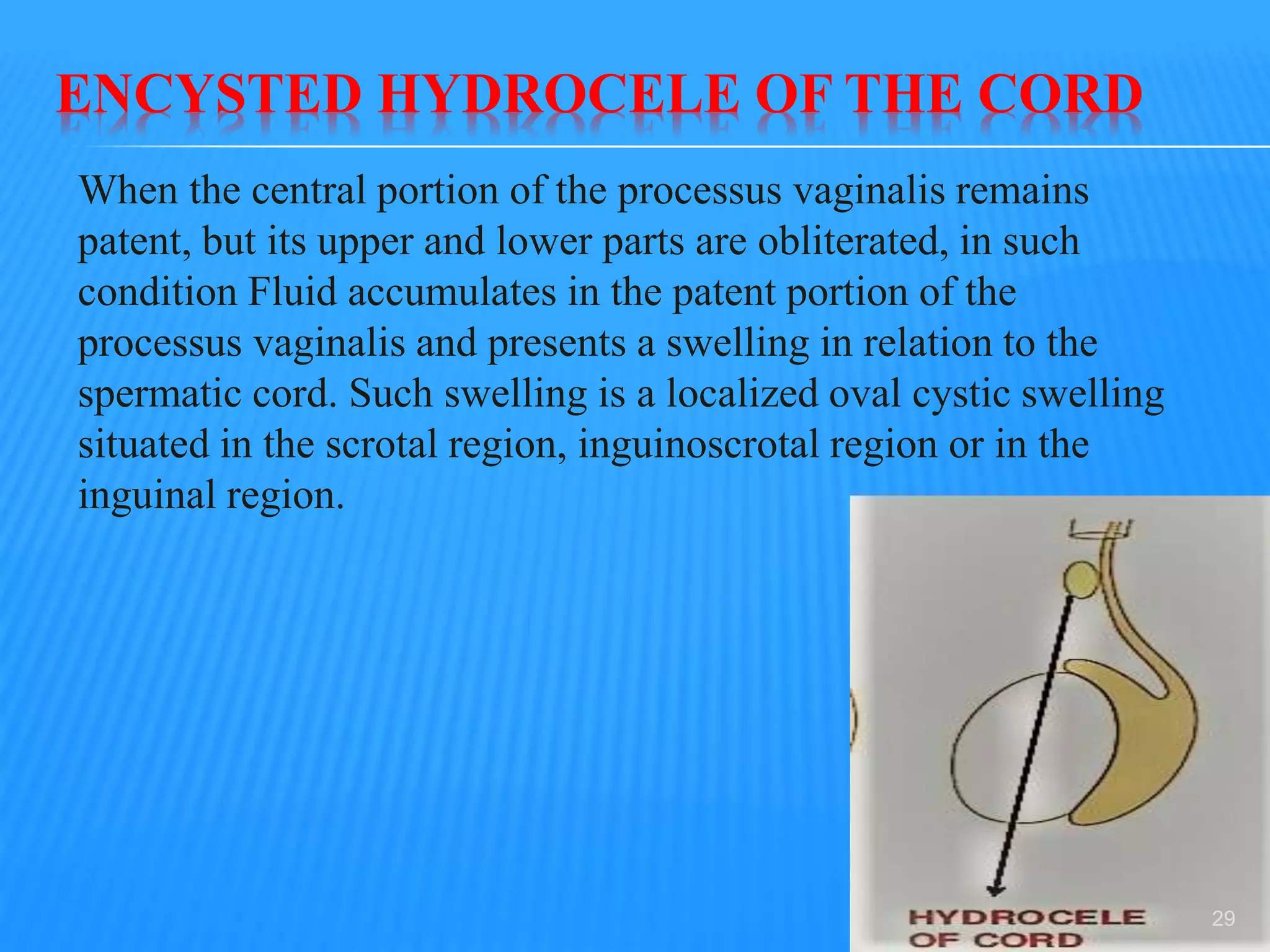 hydrocele ppt final.pptx